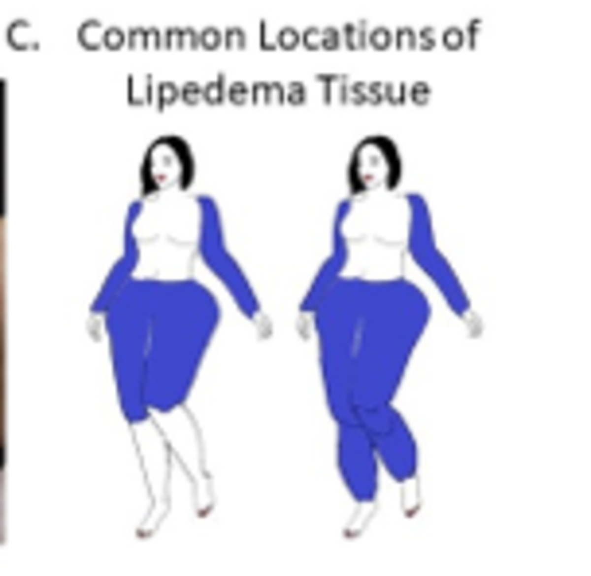 Understanding Fat Tissue Disorders and Lipomas - A Womans Health
